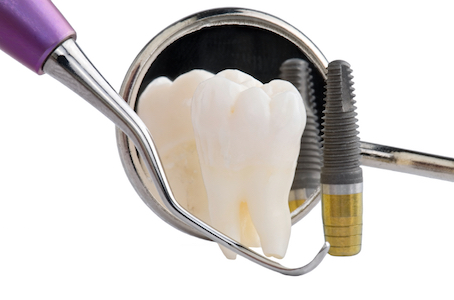 Helpful In Supporting Remaining Teeth | Anchorage Midtown Dental Center